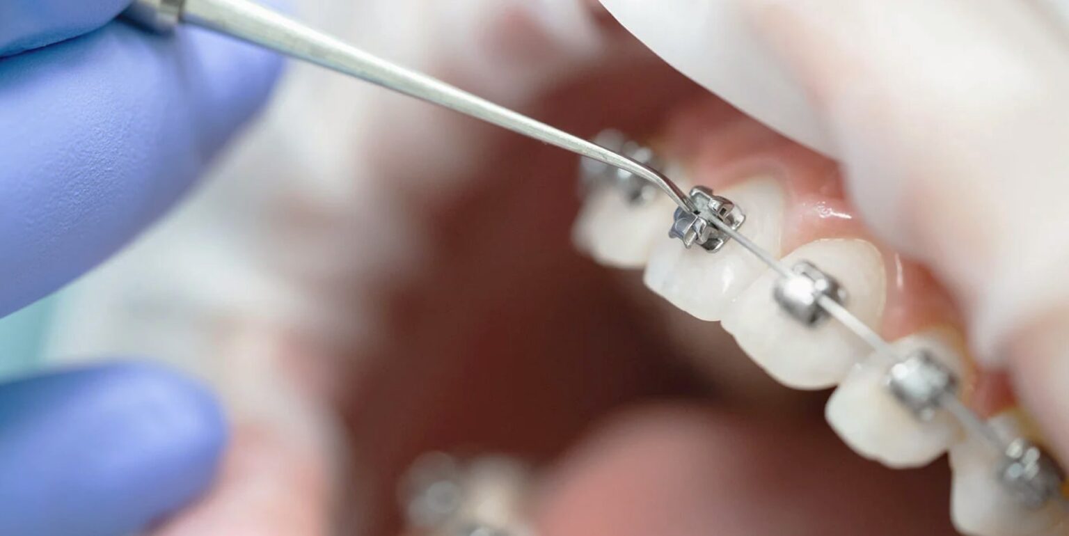 จัดฟันที่ไหนดี จัดฟันมีแบบไหนบ้าง - Gentle Peach Dental Clinic