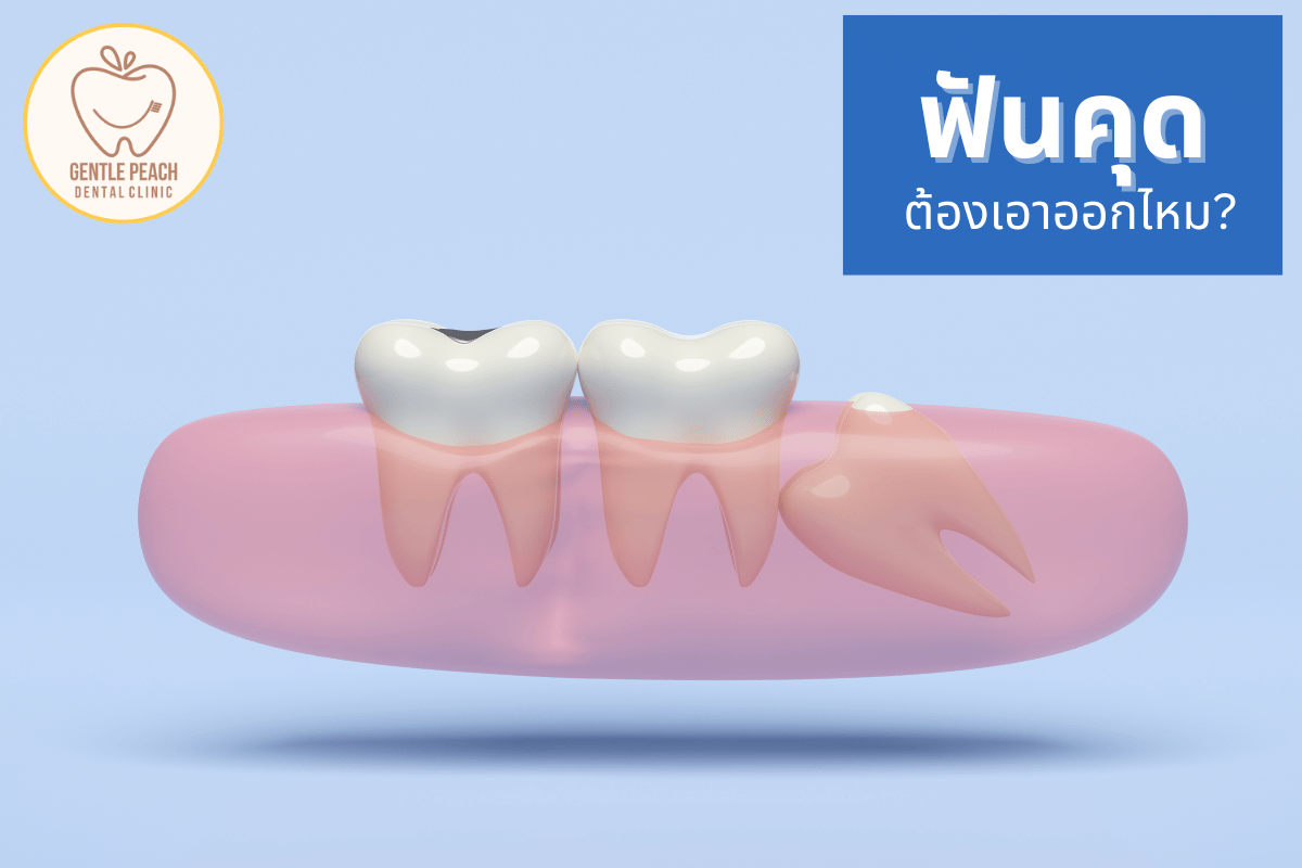 ไม่ปวดฟันคุด ต้องผ่าออกไหม - Gentle Peach Dental Clinic